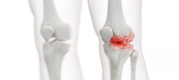 Arthrose Knie - Das kannst du gegen die Schmerzen im Knie tun